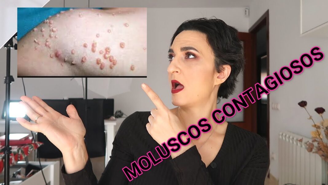 5 efectivos remedios caseros para eliminar el molusco contagioso en ...