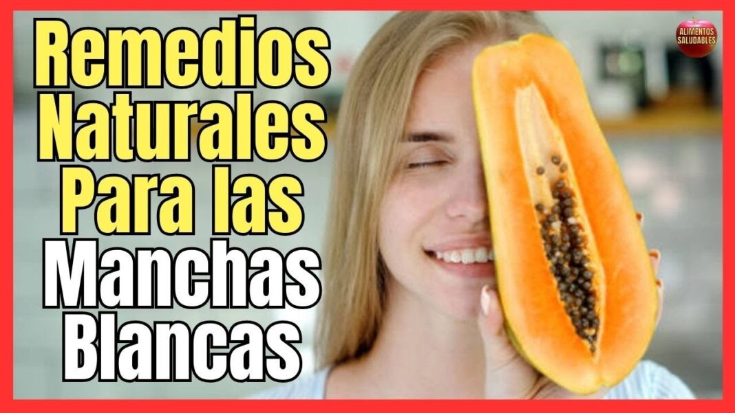 Remedios Caseros Efectivos para Eliminar las Manchas Blancas en la Piel - Remedios Caseros